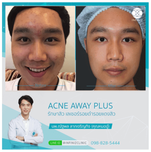 โปรแกรมรักษาสิว - Infiniz Clinic คลินิกเสริมความงาม