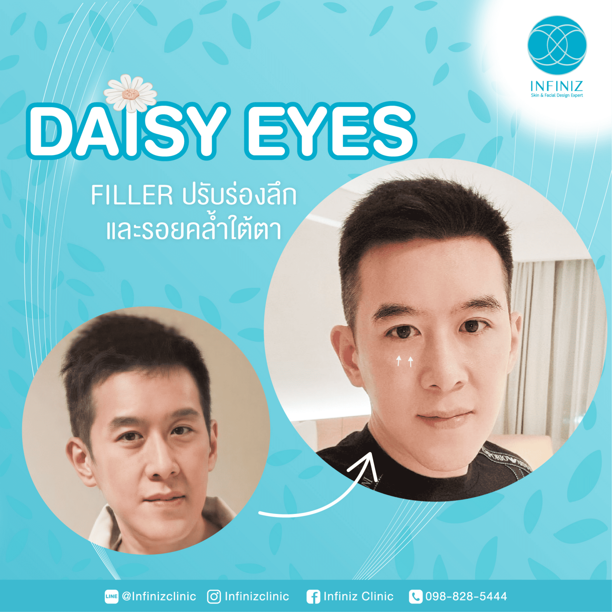Daisy Eyes - Infiniz Clinic คลินิกเสริมความงาม