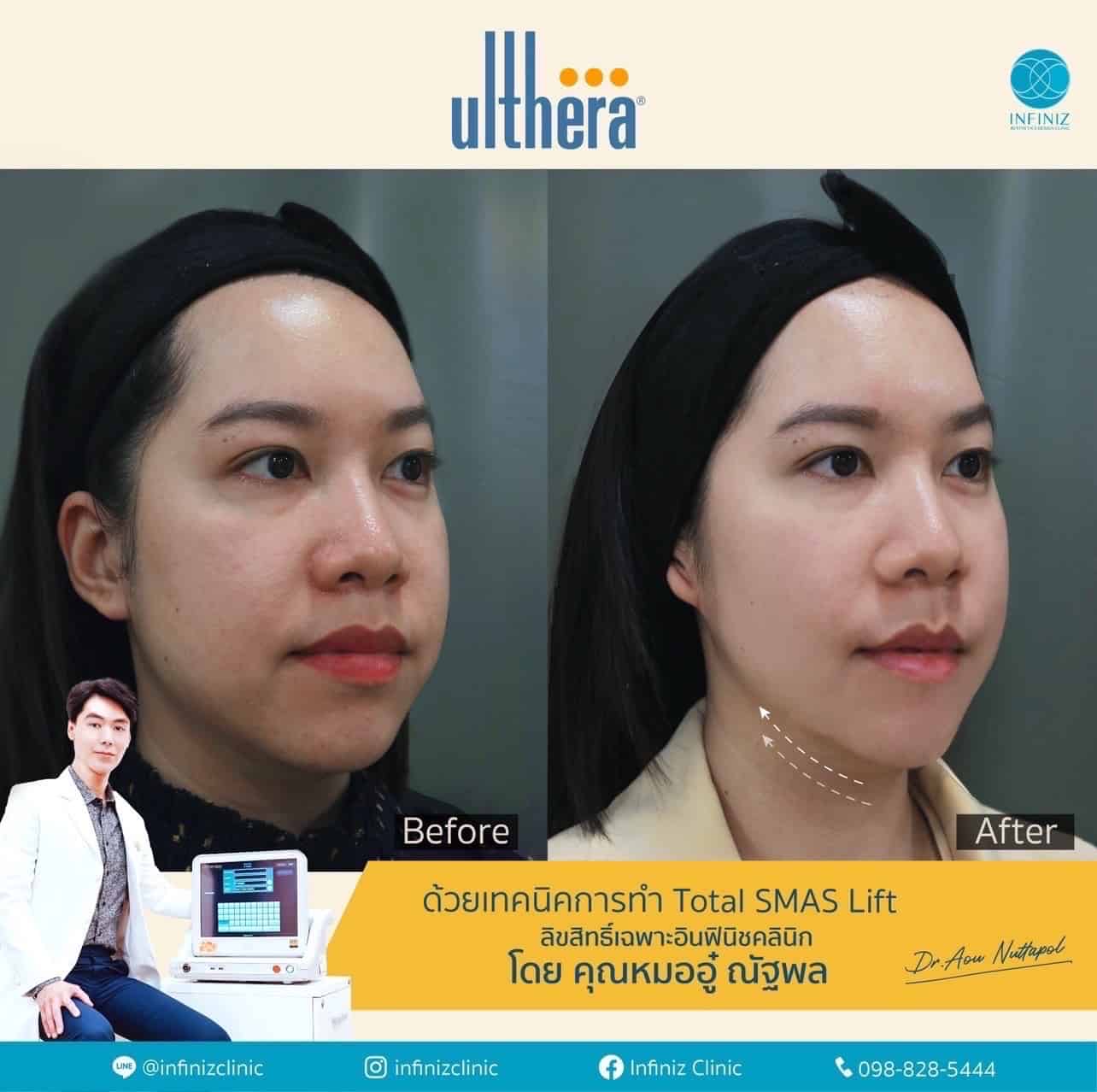 Ulthera คืออะไร? เหมาะกับใครบ้าง? สิ่งที่ต้องรู้ก่อนทำ อัลเทอร่า