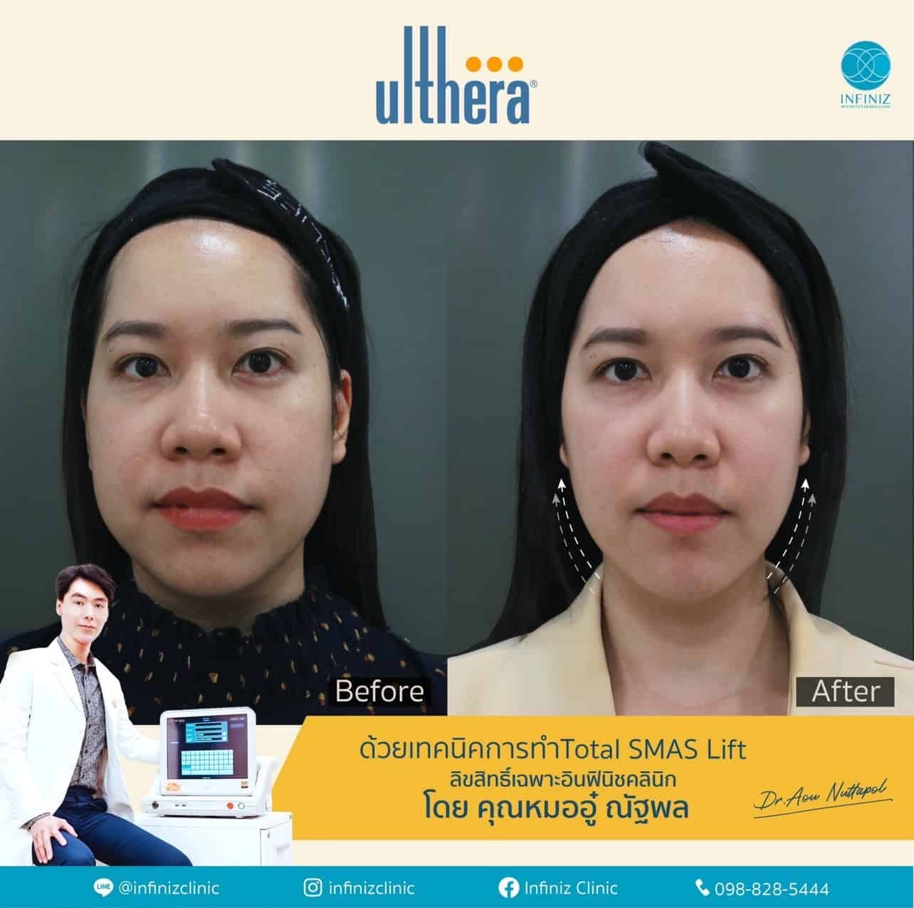 Ulthera คืออะไร? เหมาะกับใครบ้าง? สิ่งที่ต้องรู้ก่อนทำ อัลเทอร่า