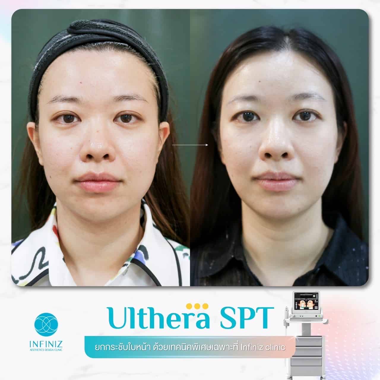 Ulthera คืออะไร? เหมาะกับใครบ้าง? สิ่งที่ต้องรู้ก่อนทำ อัลเทอร่า