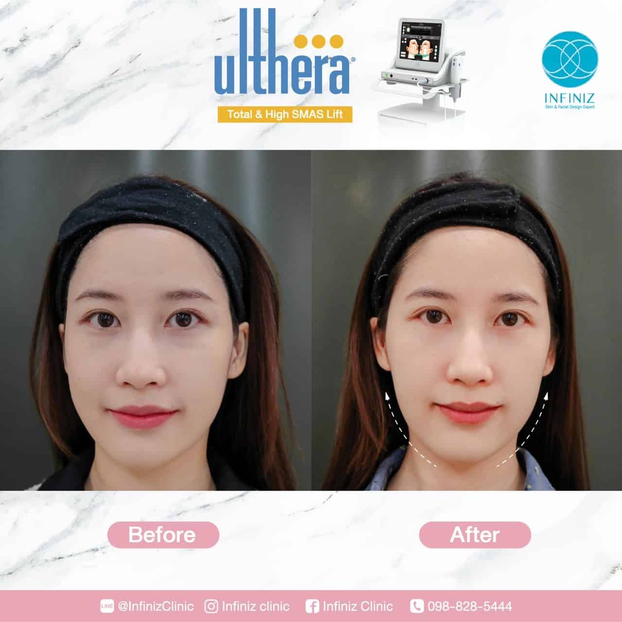 Ulthera คืออะไร? เหมาะกับใครบ้าง? สิ่งที่ต้องรู้ก่อนทำ อัลเทอร่า