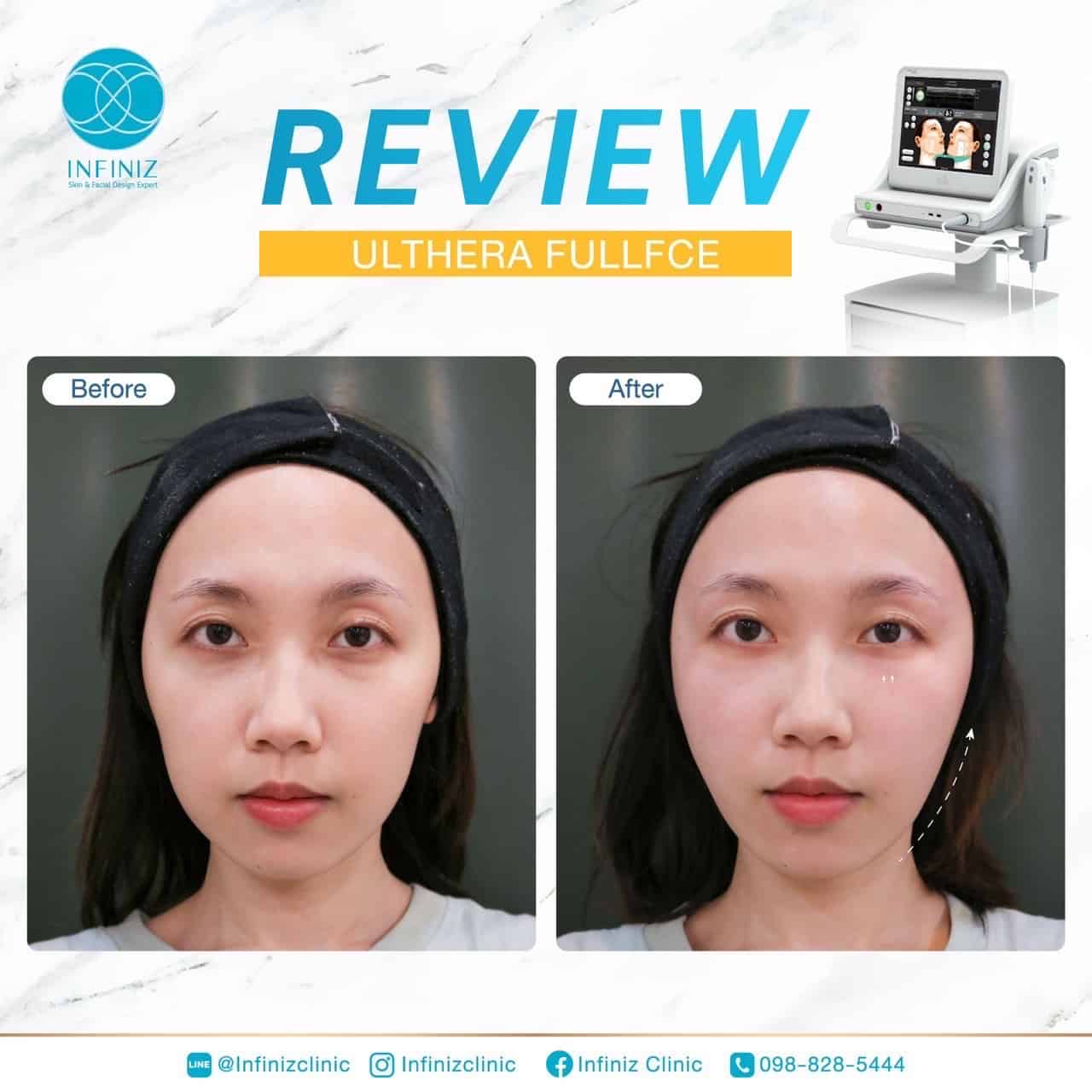 Ulthera คืออะไร? เหมาะกับใครบ้าง? สิ่งที่ต้องรู้ก่อนทำ อัลเทอร่า