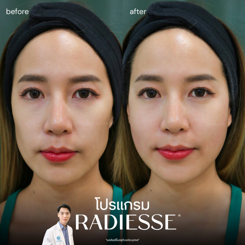 Radiesse รีวิวจัดเต็ม ทำไมถึงควรฉีดเรเดียส พร้อมรีวิวข้อดีที่น่าสนใจ