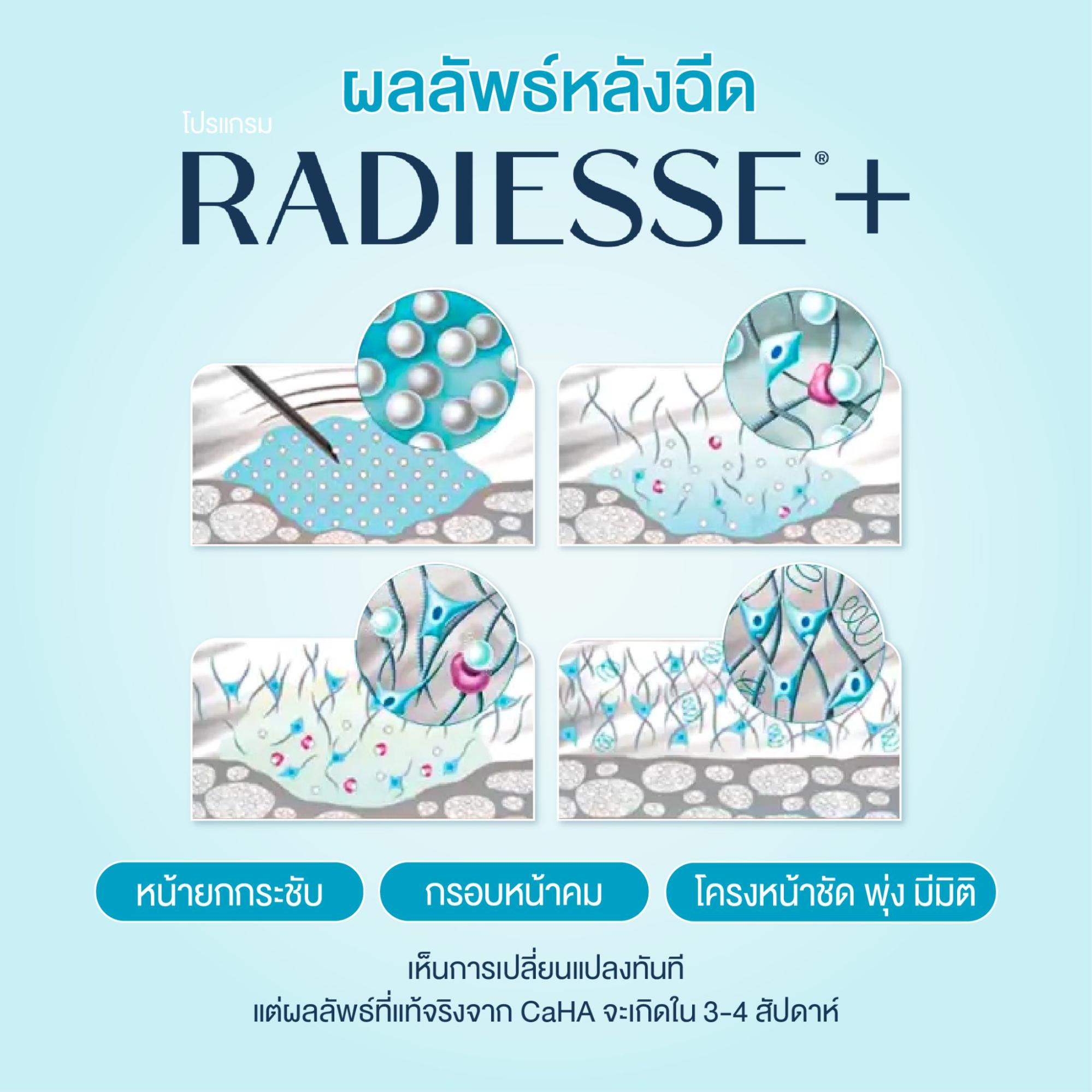 Radiesse Plus คืออะไร? ต่างจาก Radiesse ทั่วไปอย่างไร?