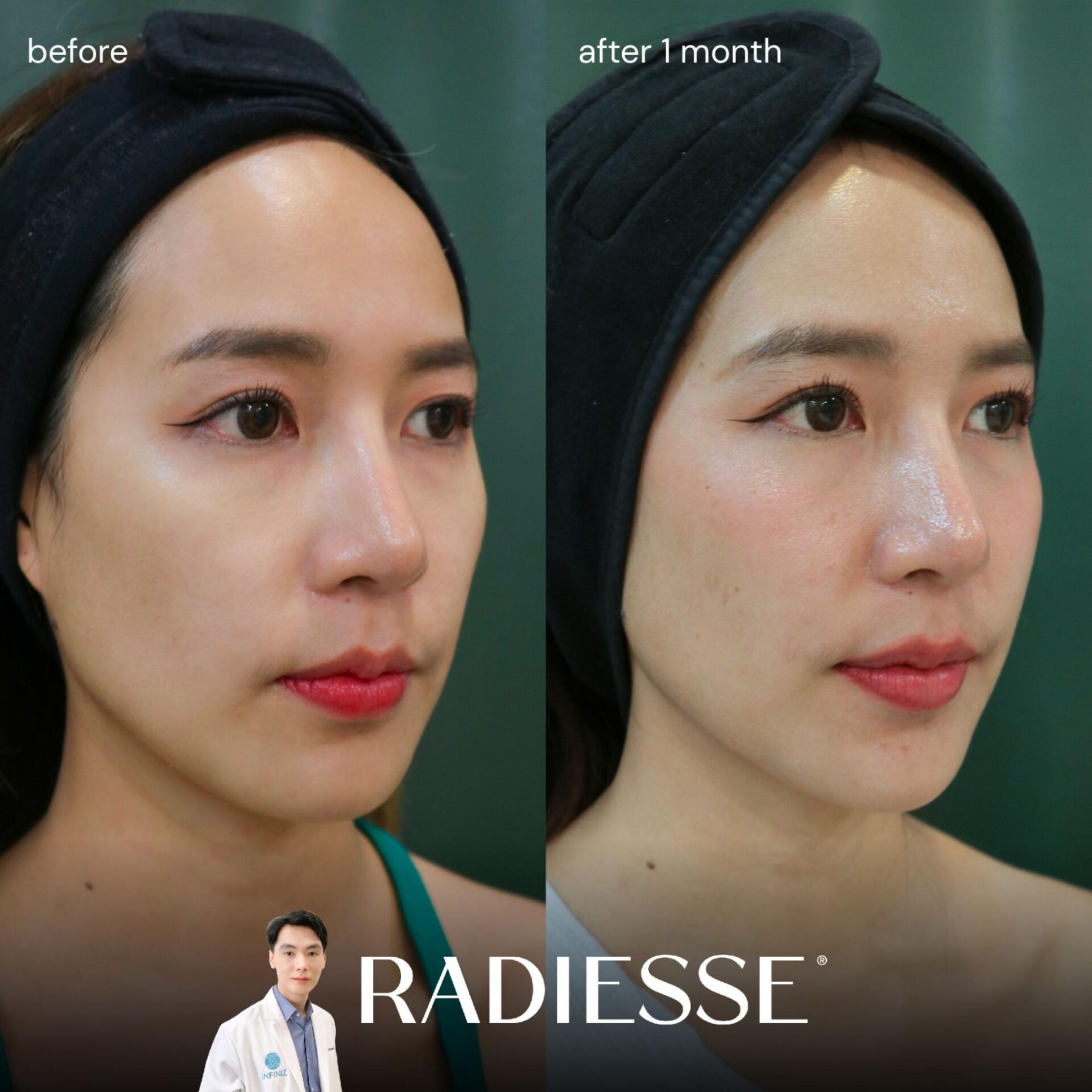 Radiesse รีวิวจัดเต็ม ทำไมถึงควรฉีดเรเดียส พร้อมรีวิวข้อดีที่น่าสนใจ