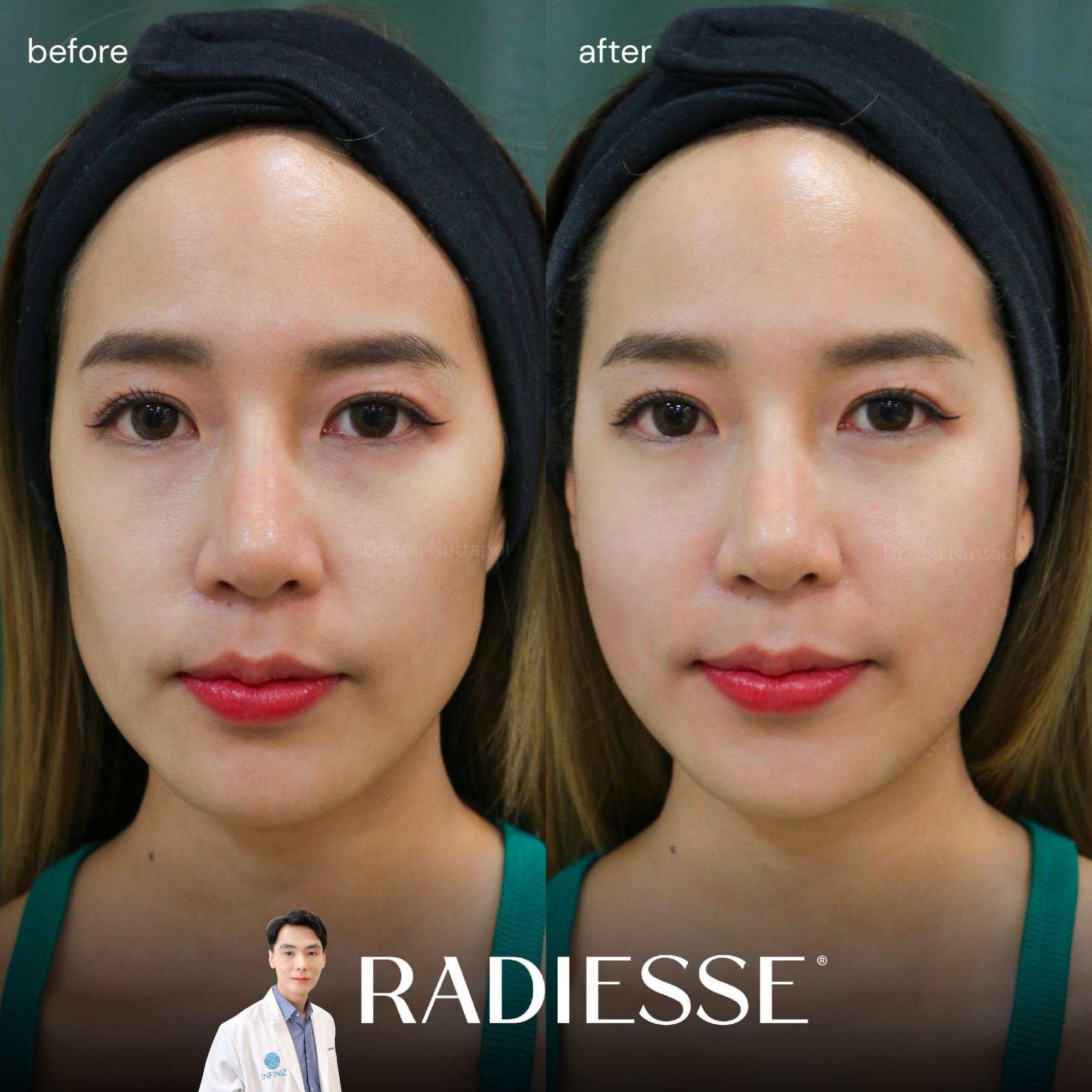 Radiesse รีวิวจัดเต็ม ทำไมถึงควรฉีดเรเดียส พร้อมรีวิวข้อดีที่น่าสนใจ