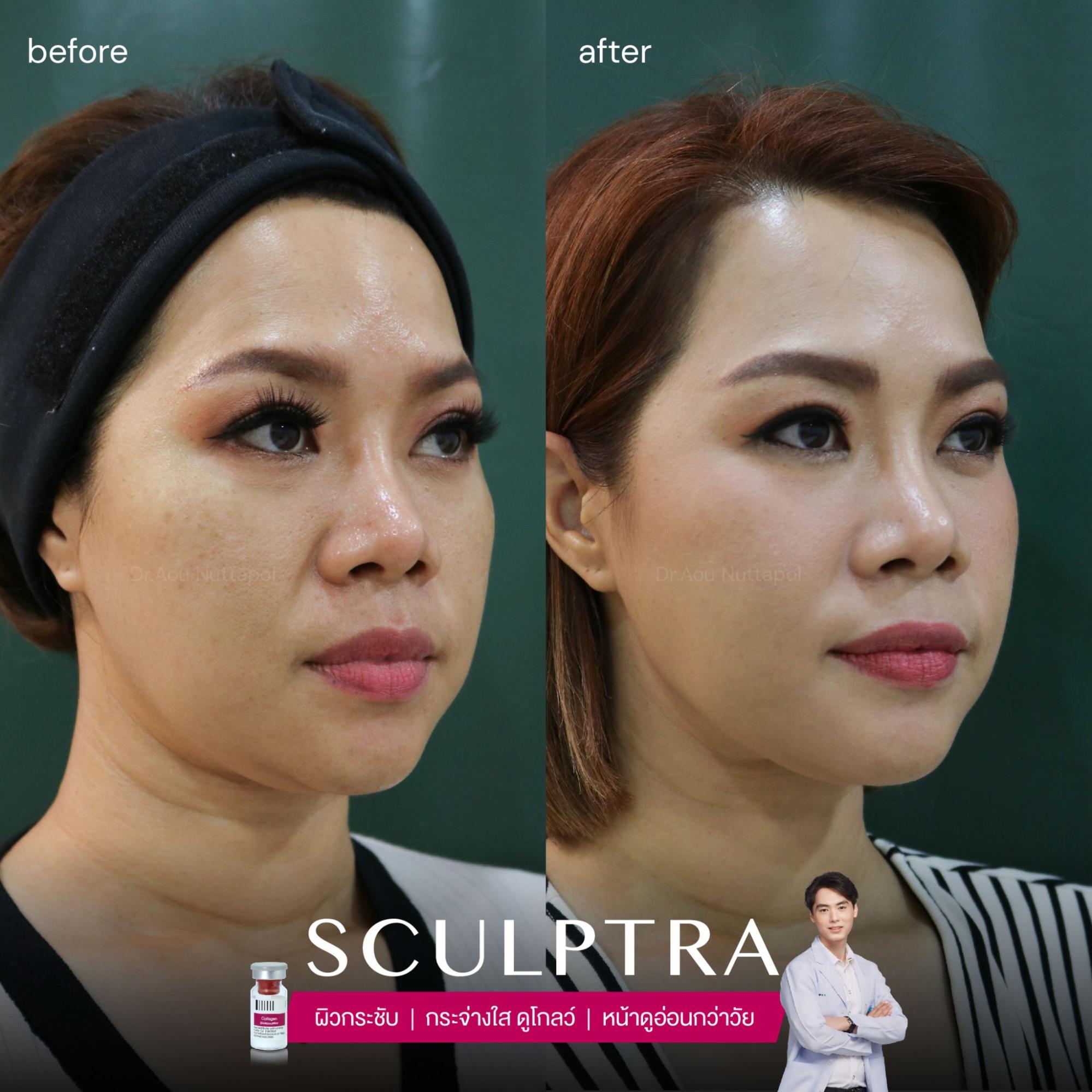 Sculptra รีวิวผลลัพธ์ ก่อน-หลังฉีด เทียบกันแบบชัด ๆ